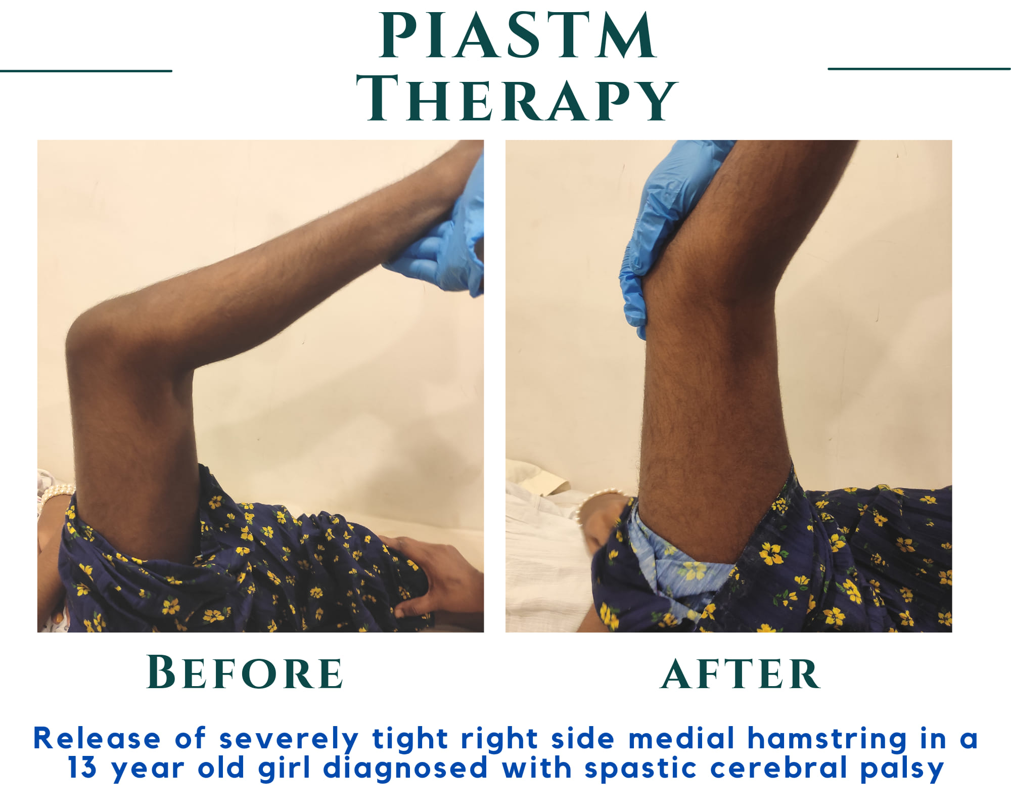 Results - PIASTM®