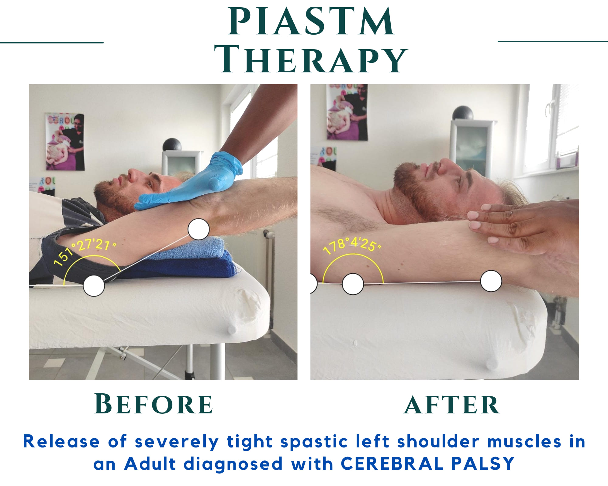 Results - PIASTM®