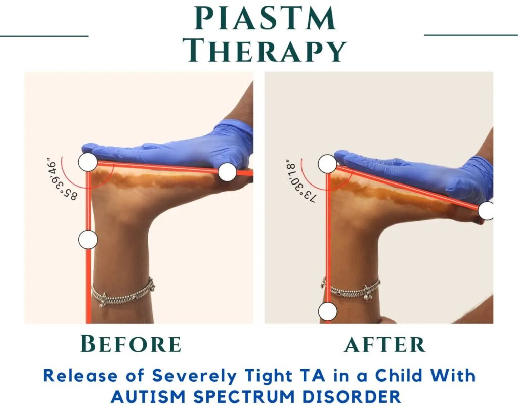 Results - PIASTM®
