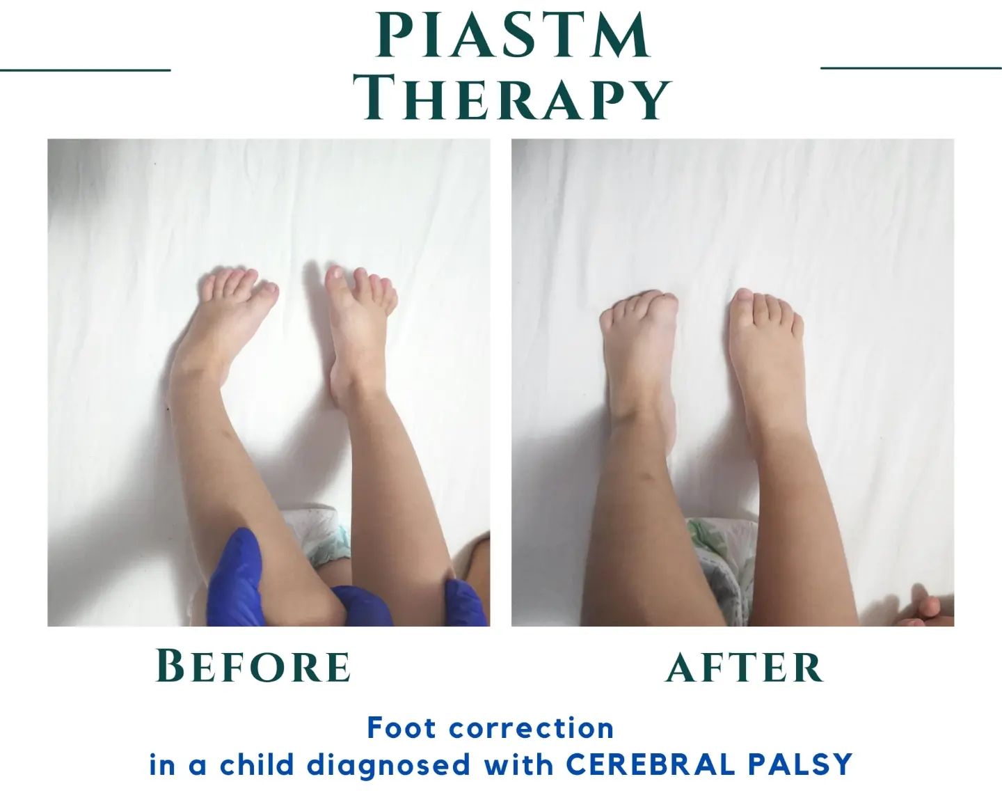 Results - PIASTM®